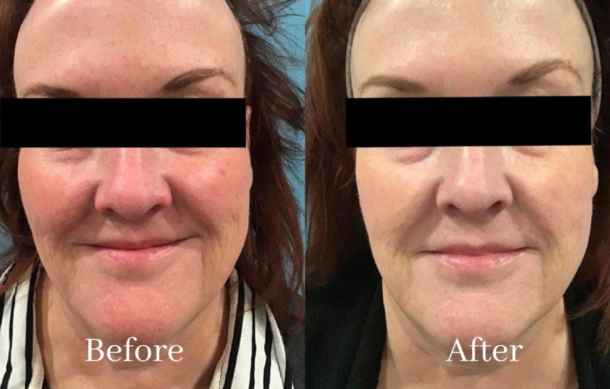 Best Broadband Light Therapy BBL Lexington, KY | Plastic Surgeons of ...